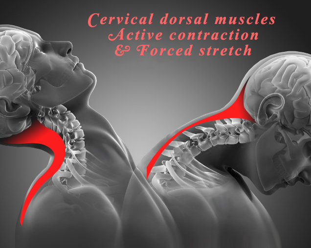 How to correct forward neck tilt? – Zenopax store